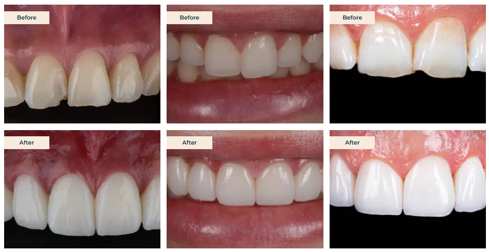 Eating Guidelines After Composite Bonding: Dos & Don’ts